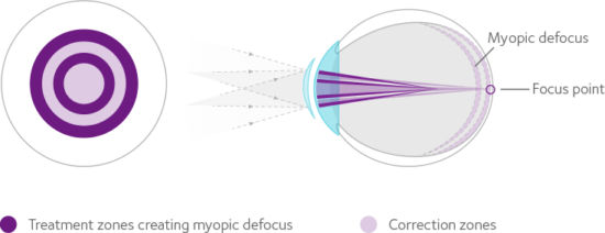 What are MiSight Contact Lenses? - Short Hills Ophthalmology